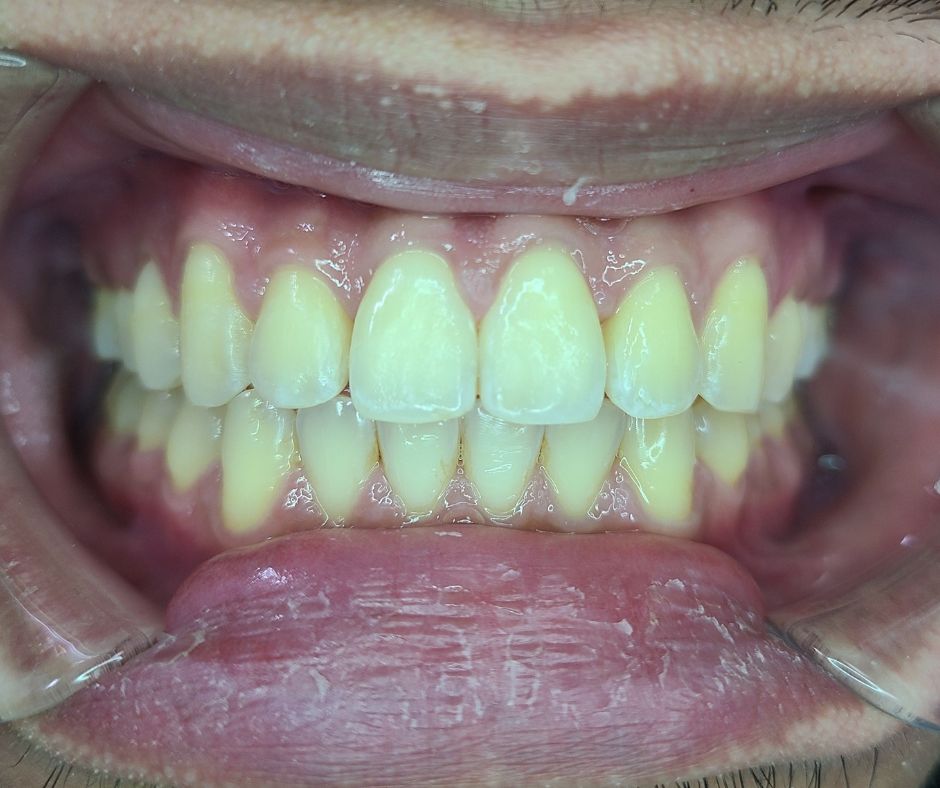 Invisalign Toronto | Tinto Dentistry